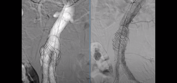 CO2 automatic angiography – Standard Technique