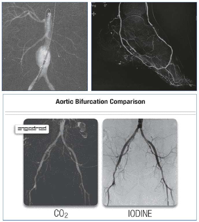Angiodroid The CO2 Injector | First of its kind