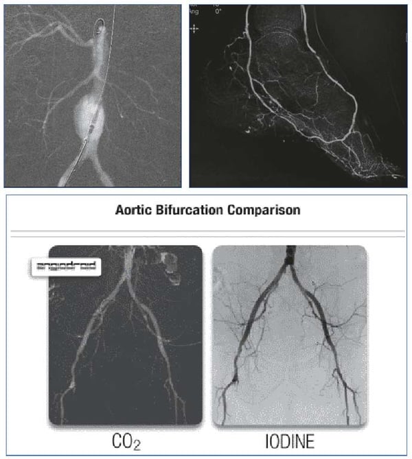 Angiodroid The CO2 Injector | First of its kind