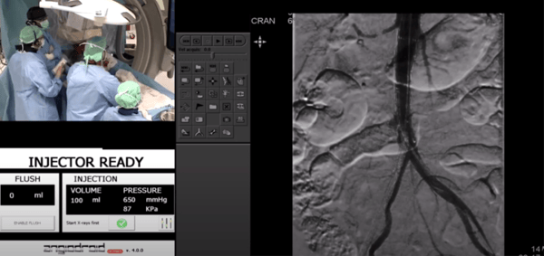 Zero Contrast Endovascular Aneurysm Repair
